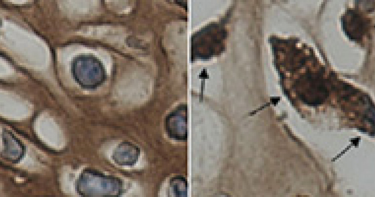Cell reprogramming recapitulates type II collagenopathy in cells and ...